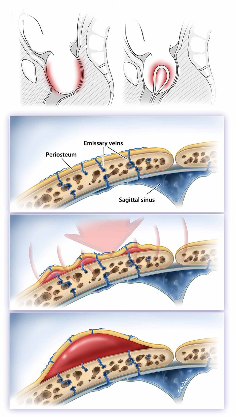 What is a cephalohematoma? | NJ Craniofacial Center